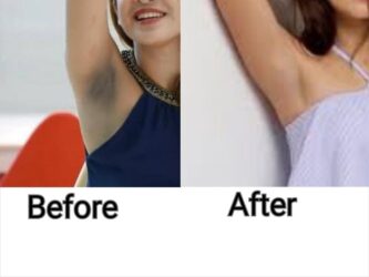 Get Rid of Dark Armpits In 48hrs Treatment, Home Remedies