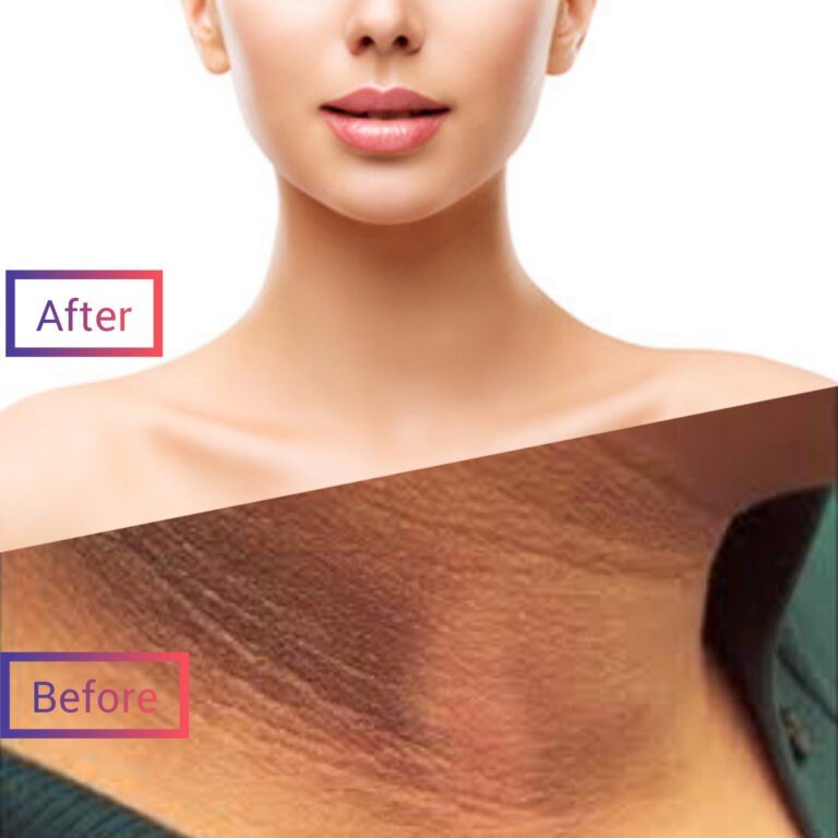Most Effective Home Remedies for a Dark Neck - SwitSmell